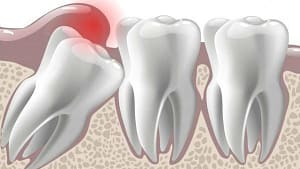 Root Canal on Wisdom Tooth: Understanding the Procedure - Smile Care ...