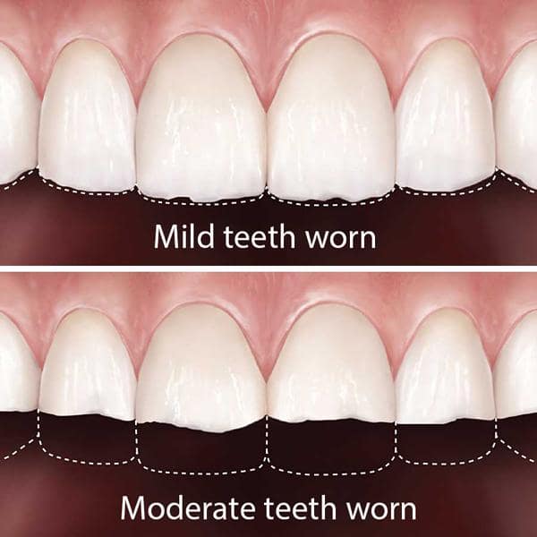 Worn Teeth: Causes, Symptoms, Treatment, and Prevention - Smile Care ...